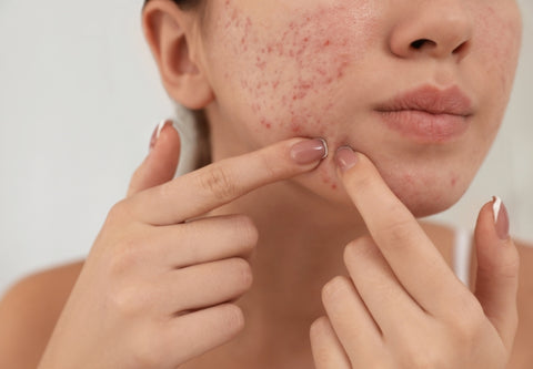 Here are the 16 Best Sulfur Acne Treatments to Heal Your Blemishes ...