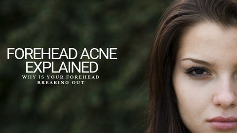 Why Is Your Forehead Breaking Out? Forehead Acne Explained | Misumi ...