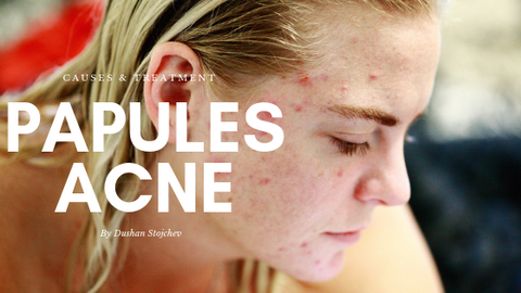 Papule Acne: Treatment and Causes | Misumi – Misumi Luxury Beauty Care